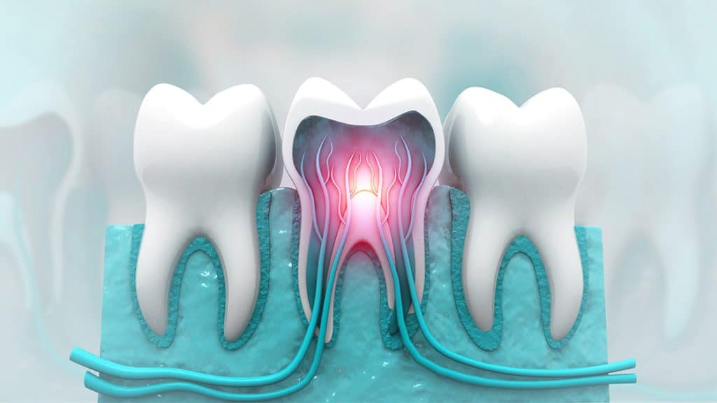 Root Resorption – Prime Endodontics